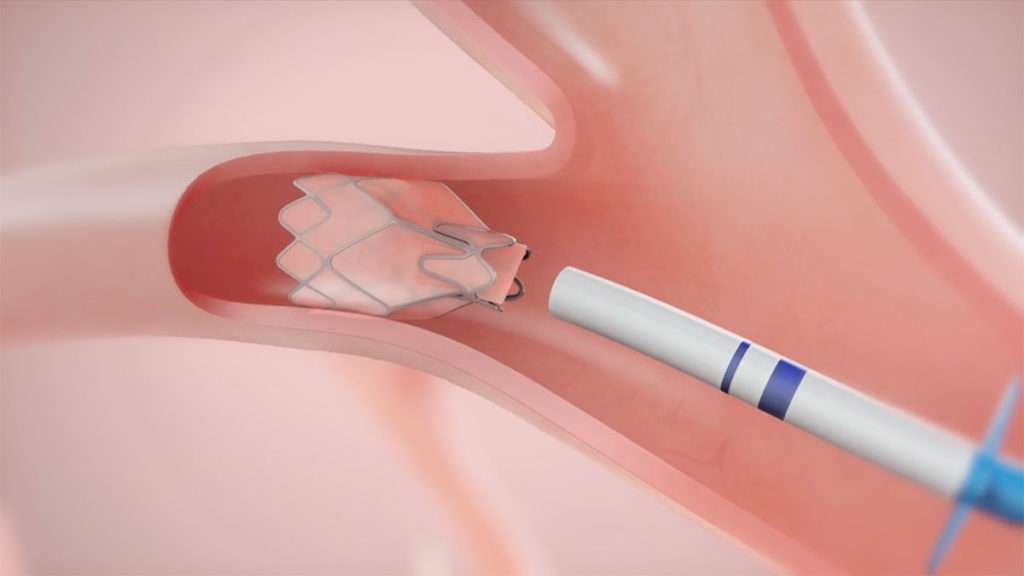 Pulmonx | Improving Breathing and Quality of Life for Emphysema Patients