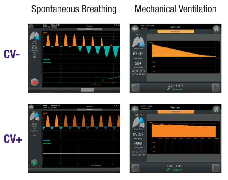 Collateral Ventilation Detection with Chartis - Pulmonx