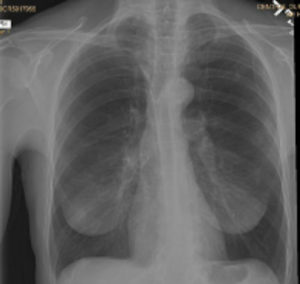 Clinical Spotlight Results after Zephyr Valve Treatment - Pulmonx