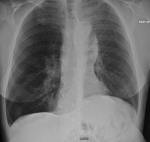Pulmonx | Clinical Spotlights