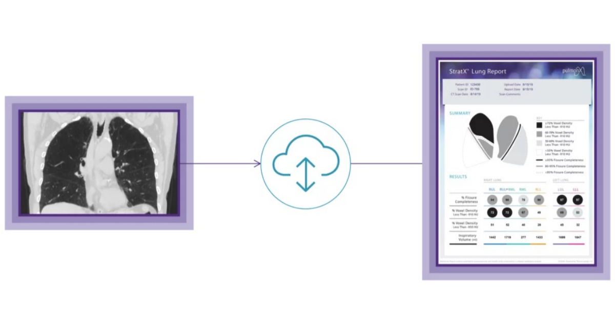 Pulmonx | StratX Lung Assessment for Emphysema Patients