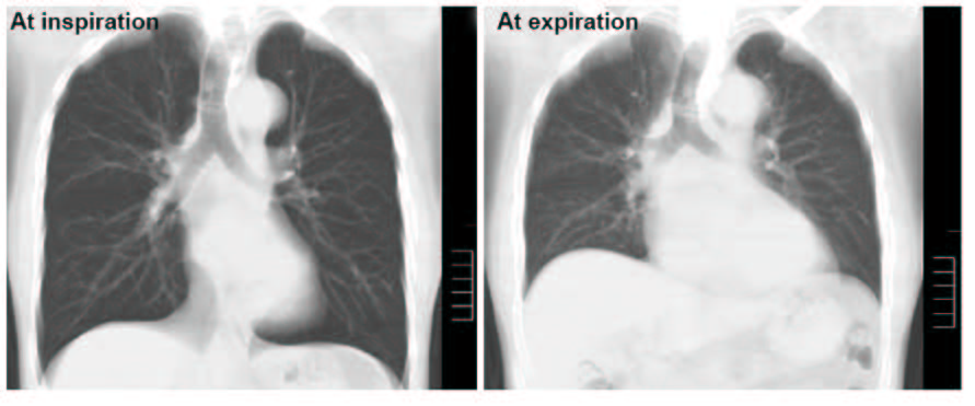 StratX CT Parameters - Pulmonx