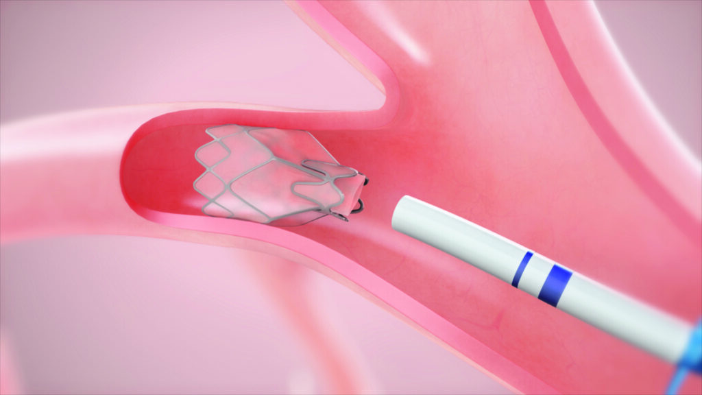 Pulmonx Zephyr Valve Chartis StratX Technology pulmonx-zephyr-valve-chartis-stratx-technology