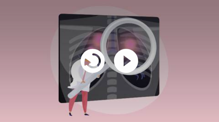 Podcasts Webinars about Zephyr Valve - Pulmonx