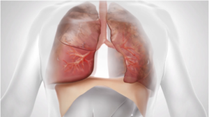 How Zephyr Works - Pulmonx